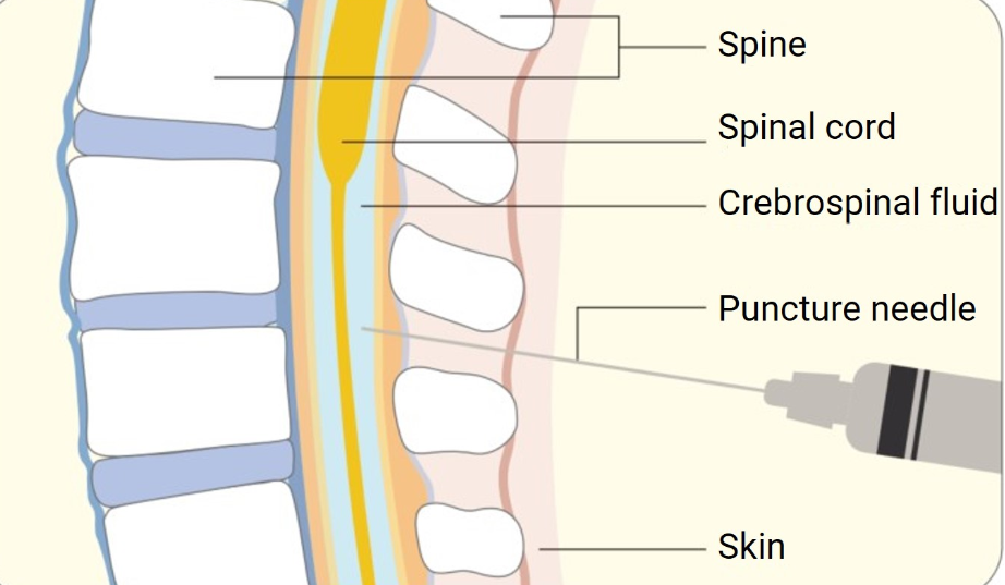 How Does Intrathecal Injection Enhance CNS Drug Delivery?
